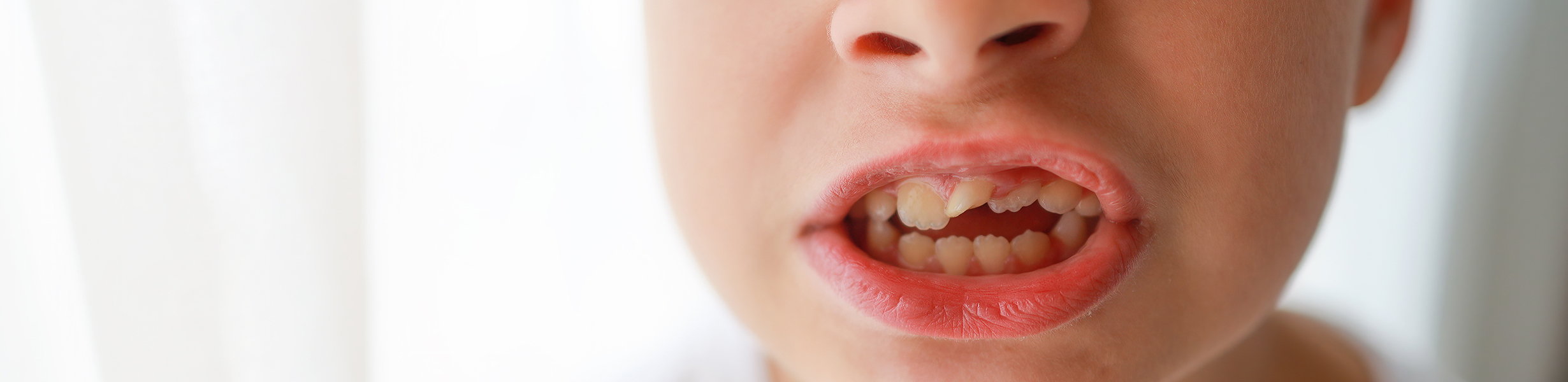 Thumbsucking Treatment The Tooth Company Orthodontics